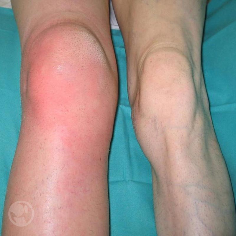 Dolor rodilla izquierda: Causas, síntomas y tratamiento